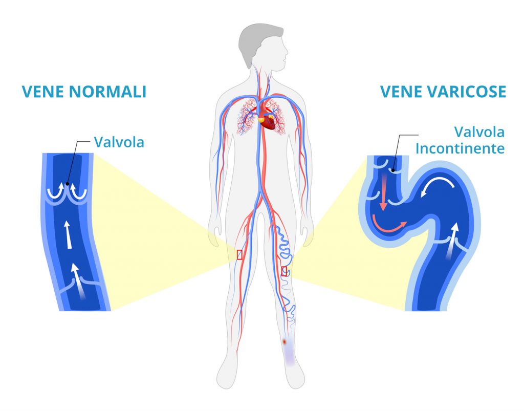 Insufficienza Venosa Cronica